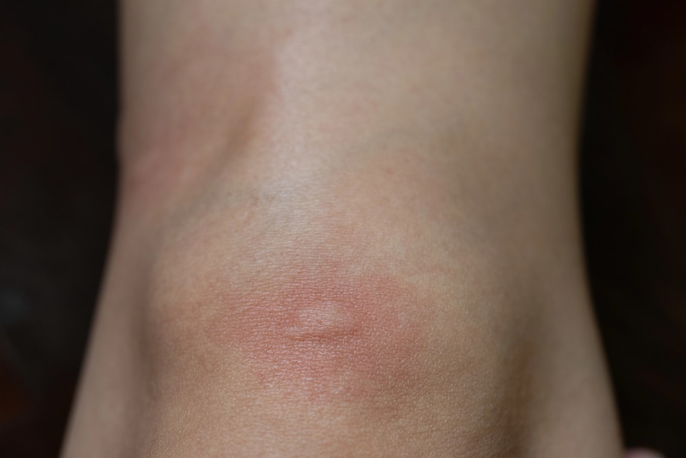 Mosquito Bites on Humans: Pictures, Treatment, and Prevention