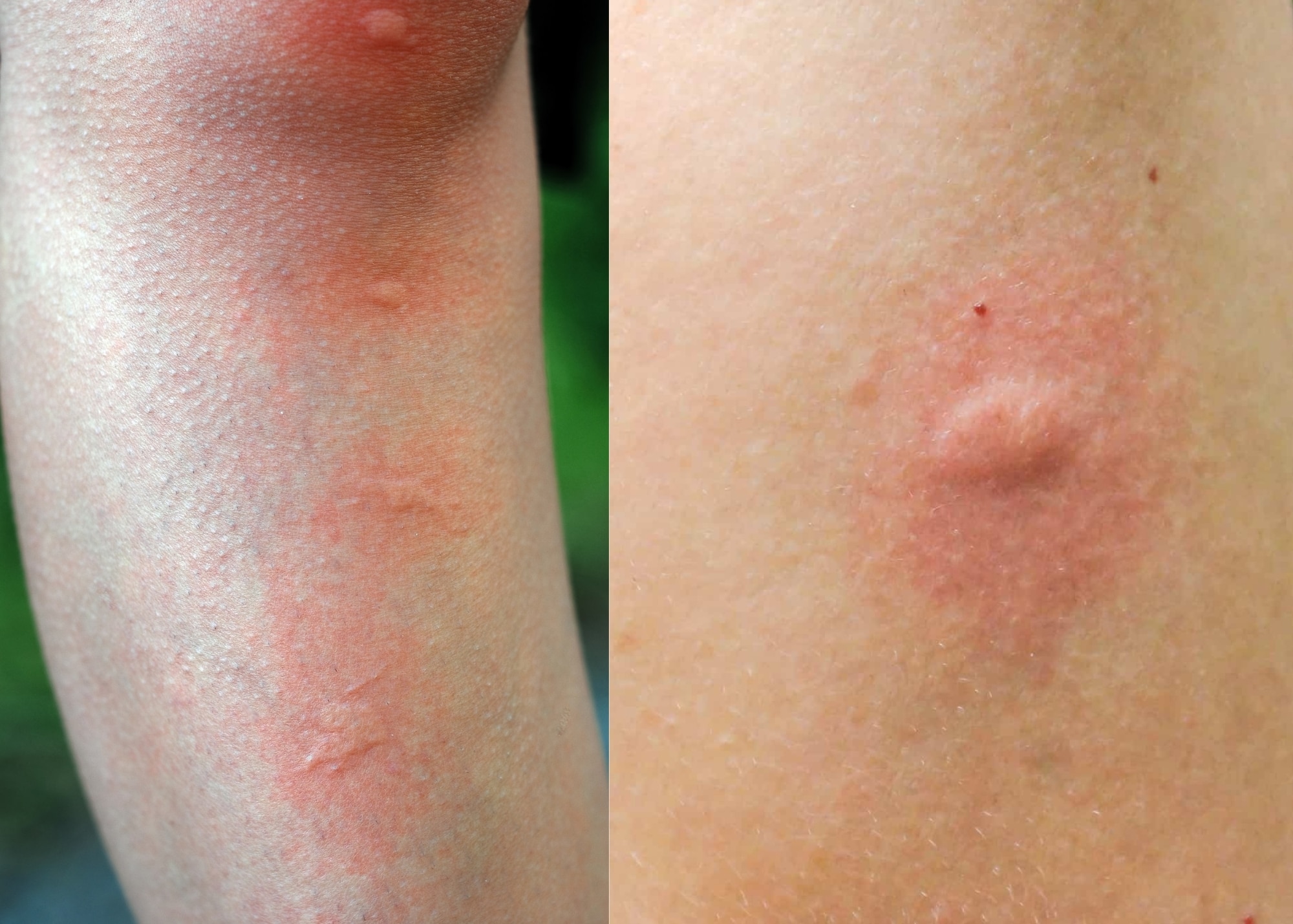 Mosquito Bites on Humans: Pictures, Treatment, and Prevention