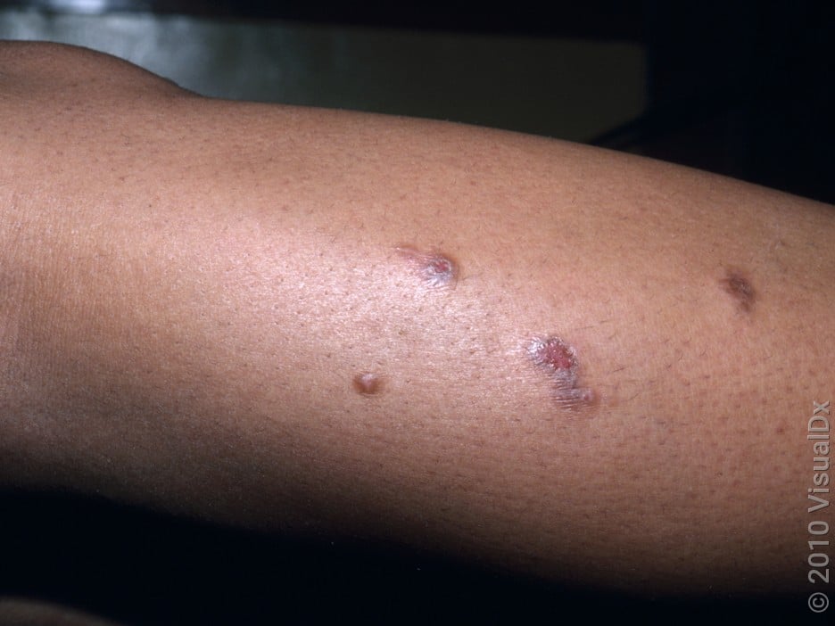 Mosquito Bites on Humans: Pictures, Treatment, and Prevention
